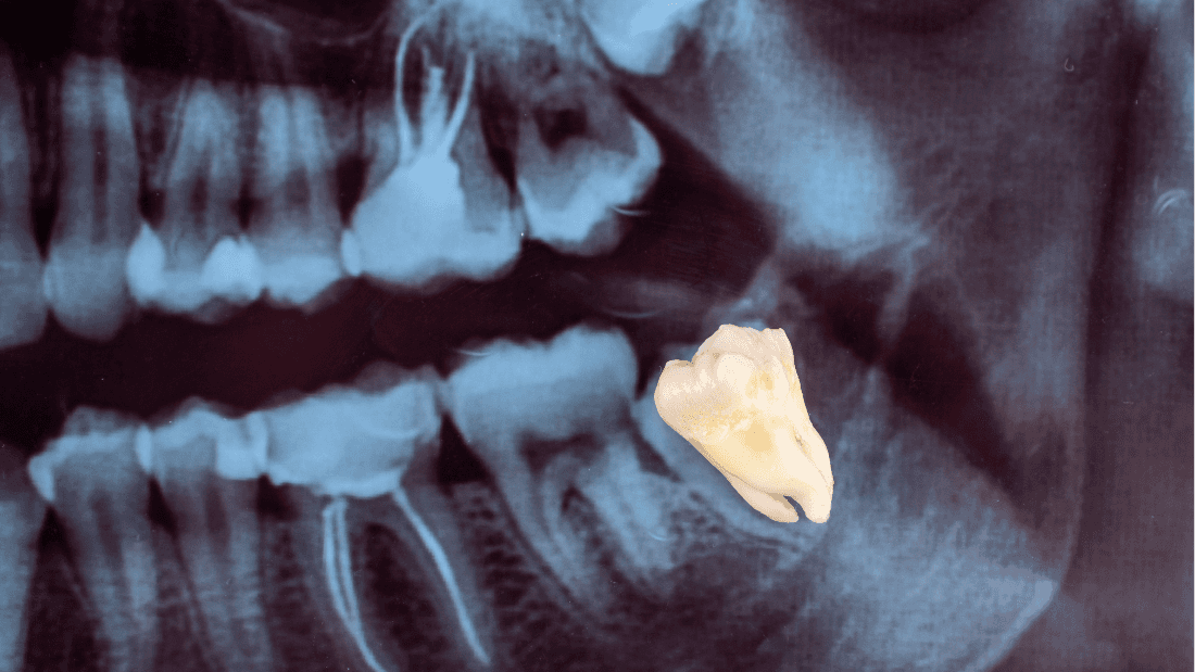 Wisdom Tooth Extraction in Royal Palm Beach: Your Complete Guide ...
